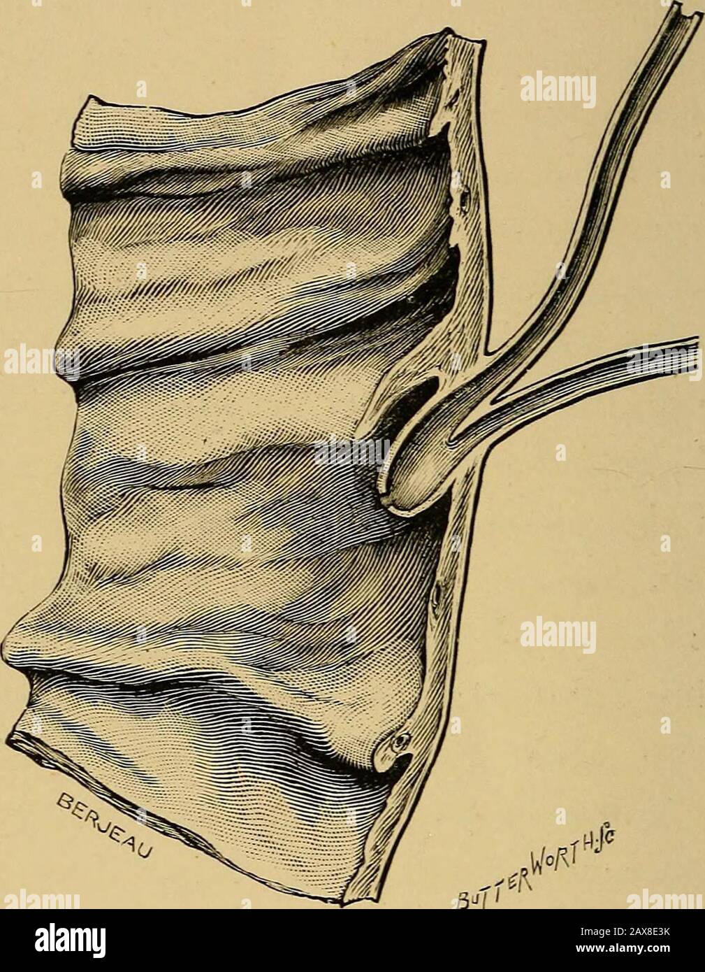 Gall-stones and diseases of the bile-ducts . omentum in front of ...