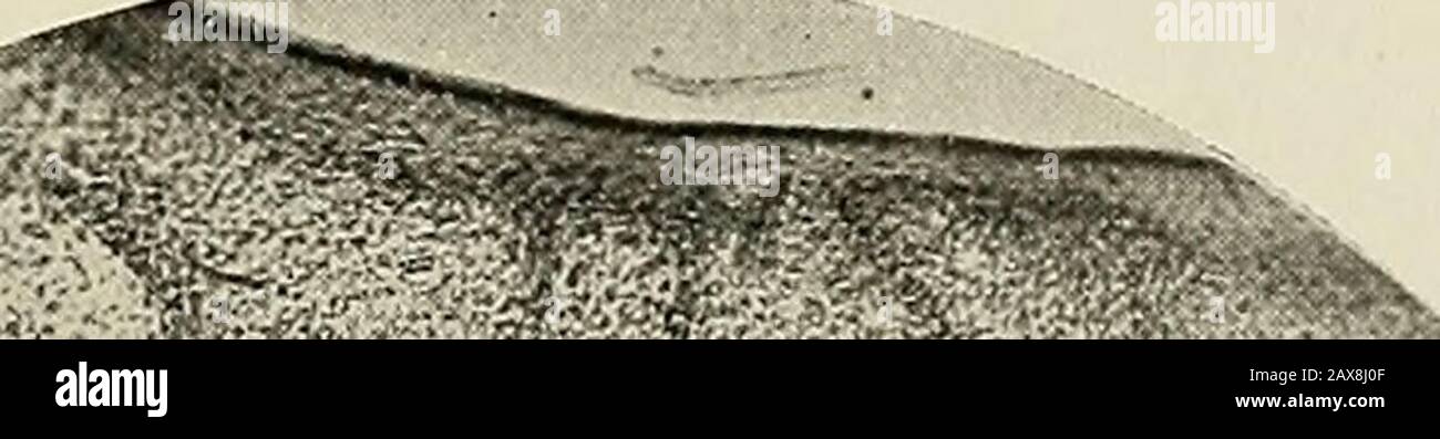 The pathology and surgical treatment of tumors . Fig. 139.—Extensive ...