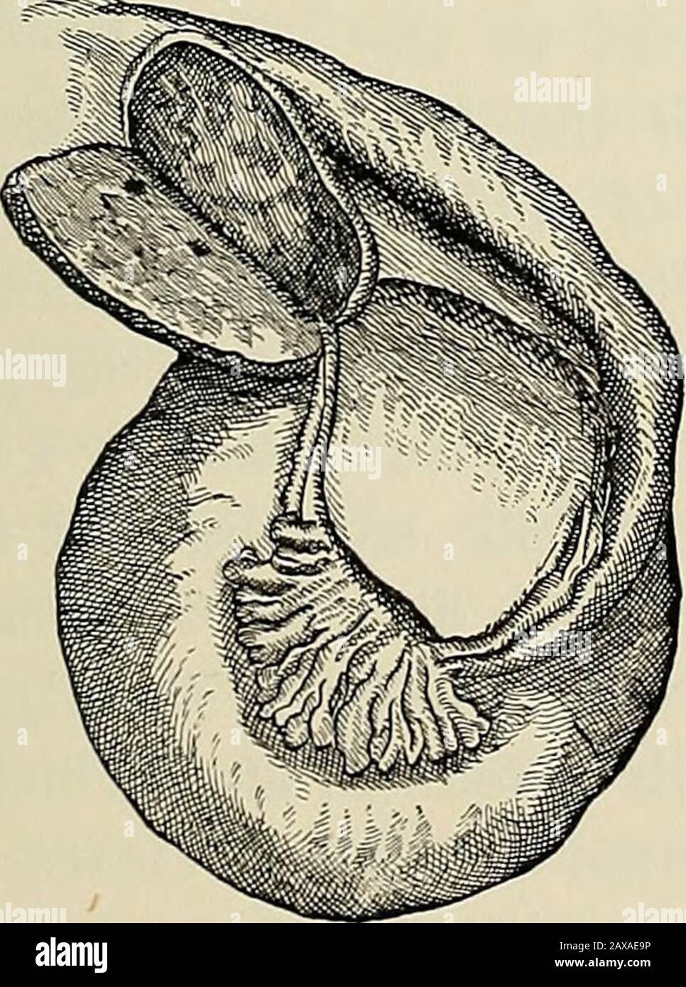 The pathology and surgical treatment of tumors . Fig. iio.—Cyst of the ...