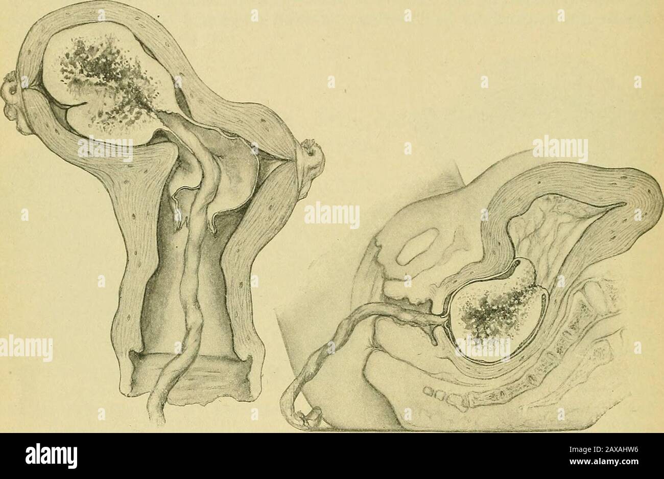 Retained placenta hi-res stock photography and images - Alamy