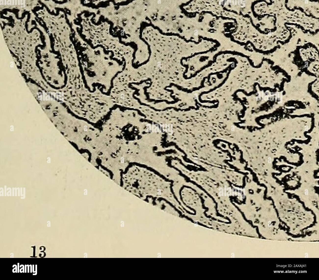 The pathology and surgical treatment of tumors Stock Photo - Alamy