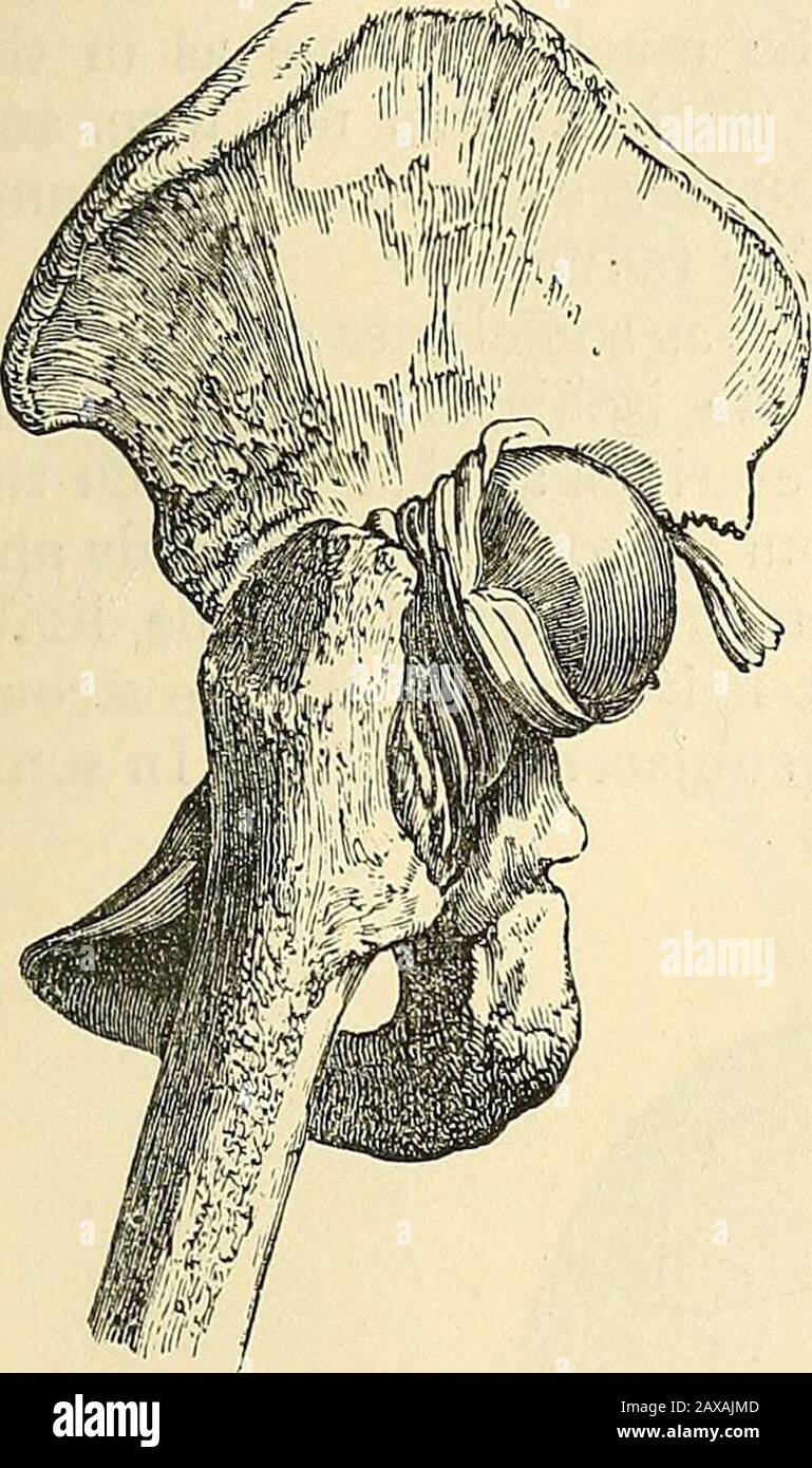 A practical treatise on fractures and dislocations . ds into the ...