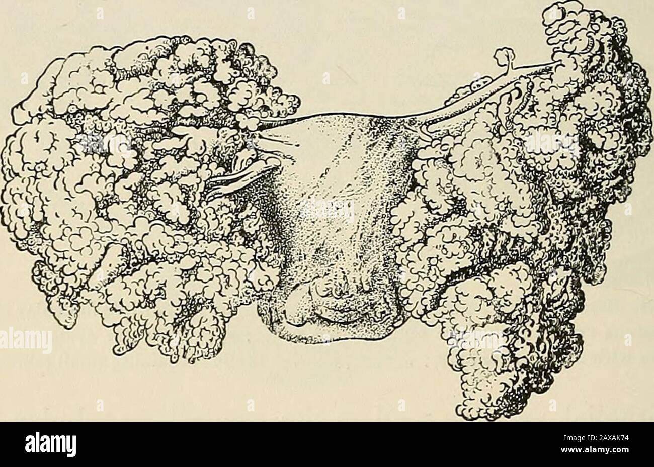 The pathology and surgical treatment of tumors . in the broad ligament ...
