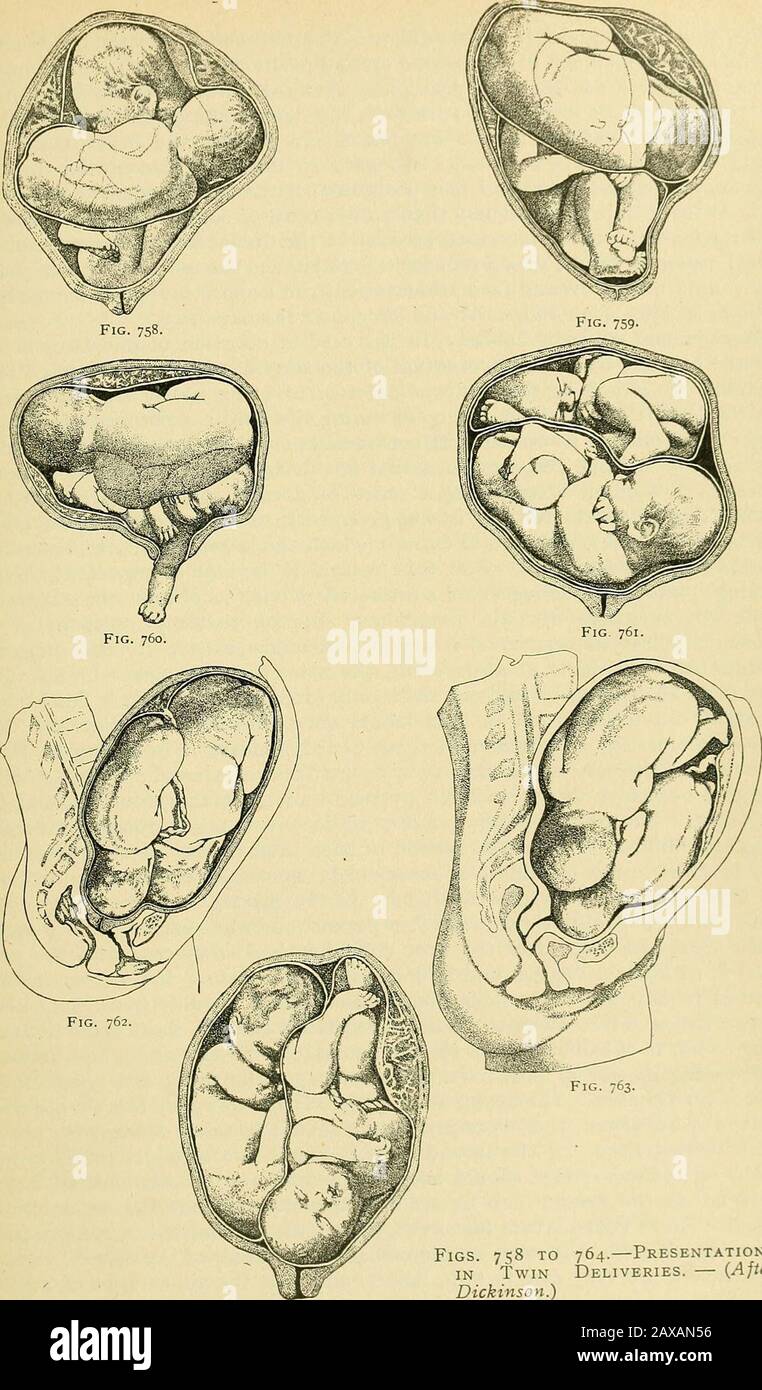 Fetal presentations hi-res stock photography and images - Alamy