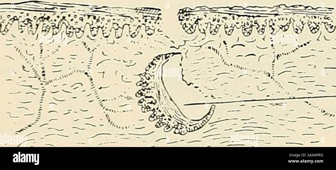 The pathology and surgical treatment of tumors . Fig. 94.—Manner of ...