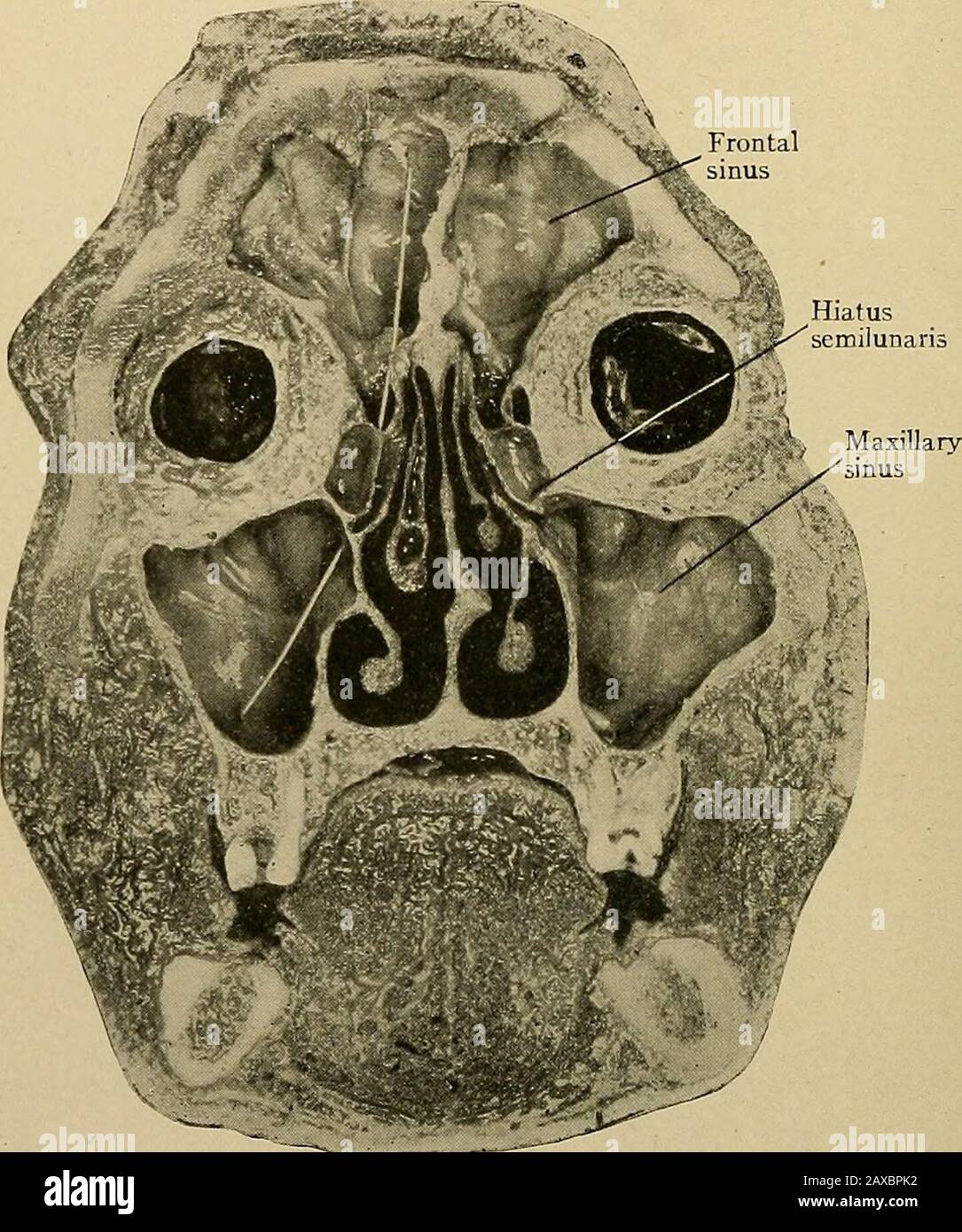 Maxillary Sinus Bone