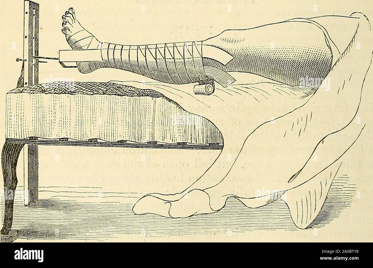 A practical treatise on fractures and dislocations . side splint must ...