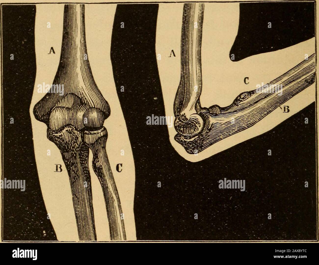 Dislocated joints hi-res stock photography and images - Alamy