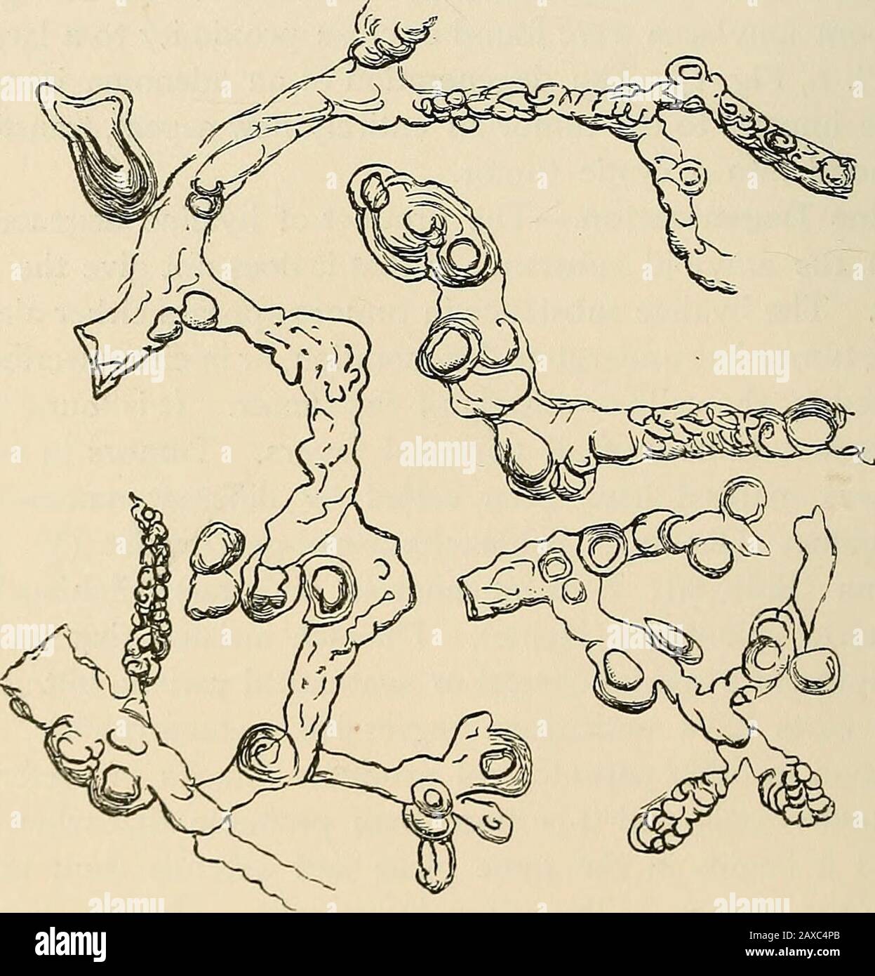 The pathology and surgical treatment of tumors . FlG. i6.—Petrifaction ...