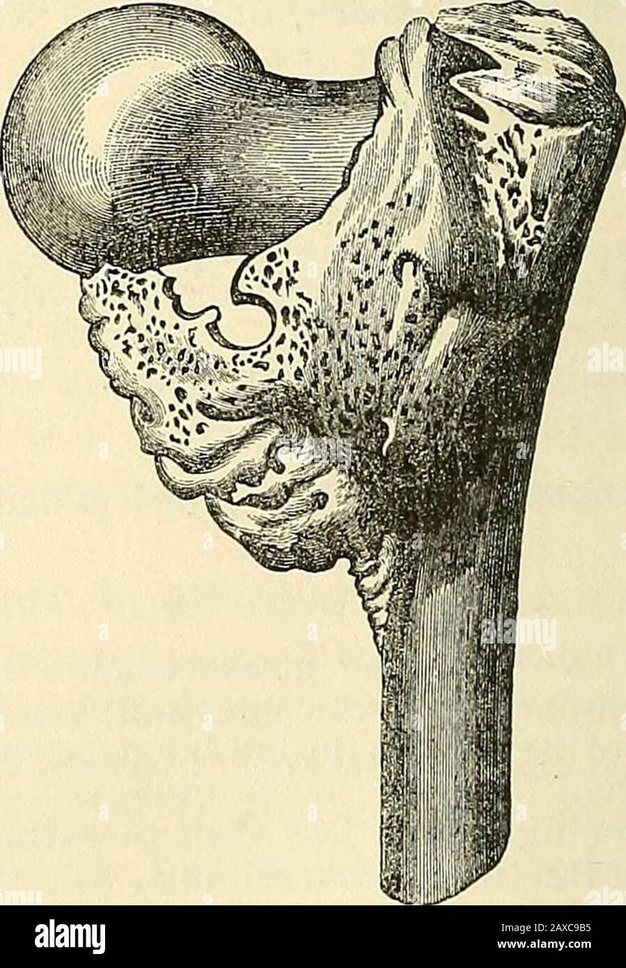 Smith fracture hi-res stock photography and images - Alamy