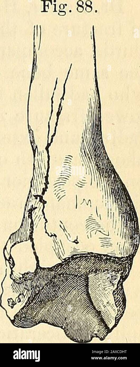 Wedge fracture hi-res stock photography and images - Alamy
