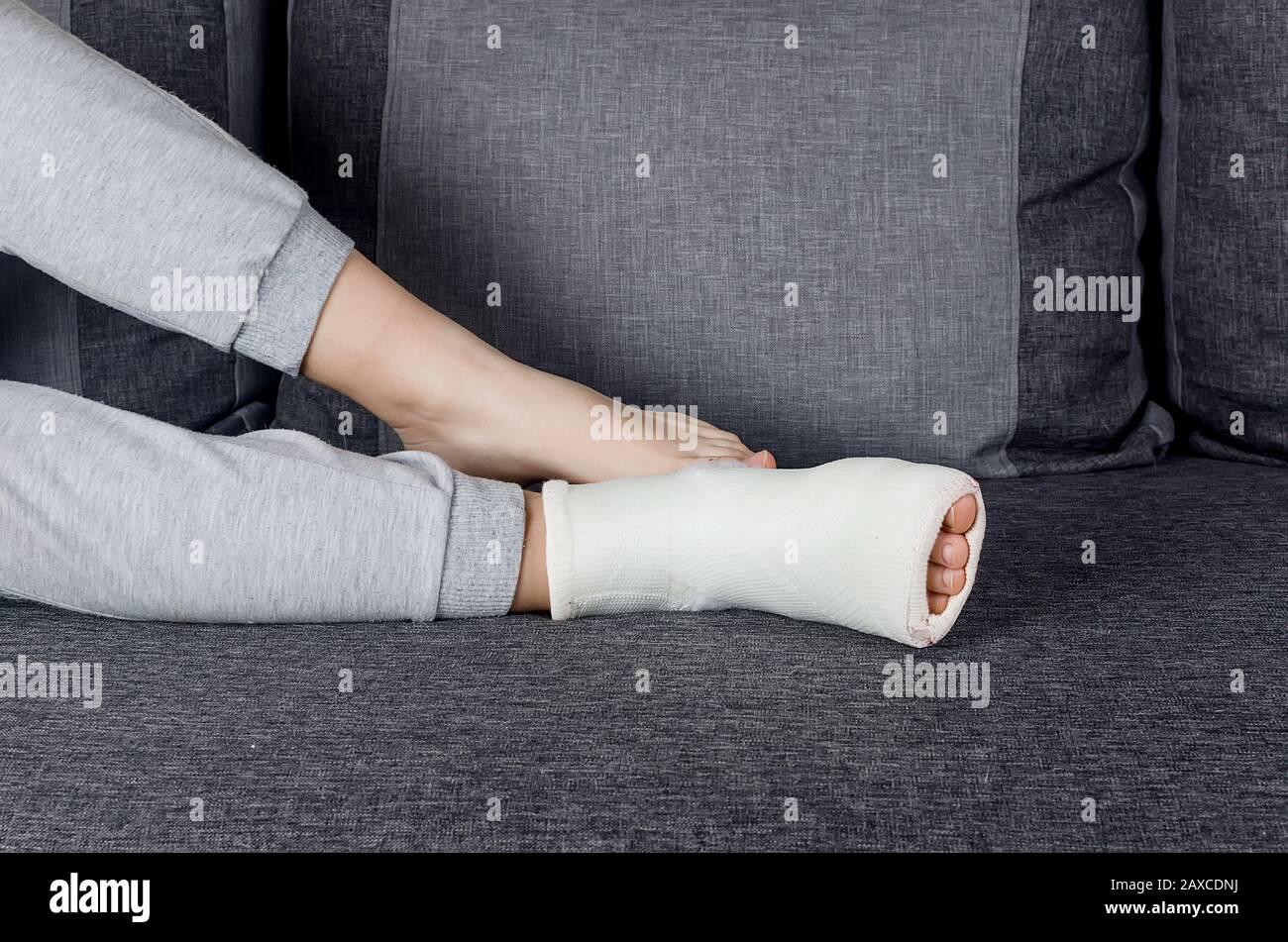 Close up of a leg young girl fiberglass. Child with Plaster bandage on ...