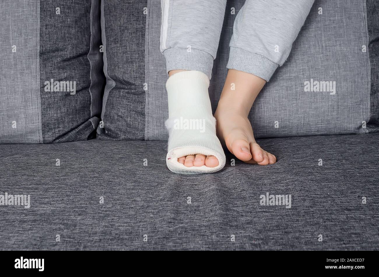 Close up of a leg young girl fiberglass. Child with Plaster bandage on ...