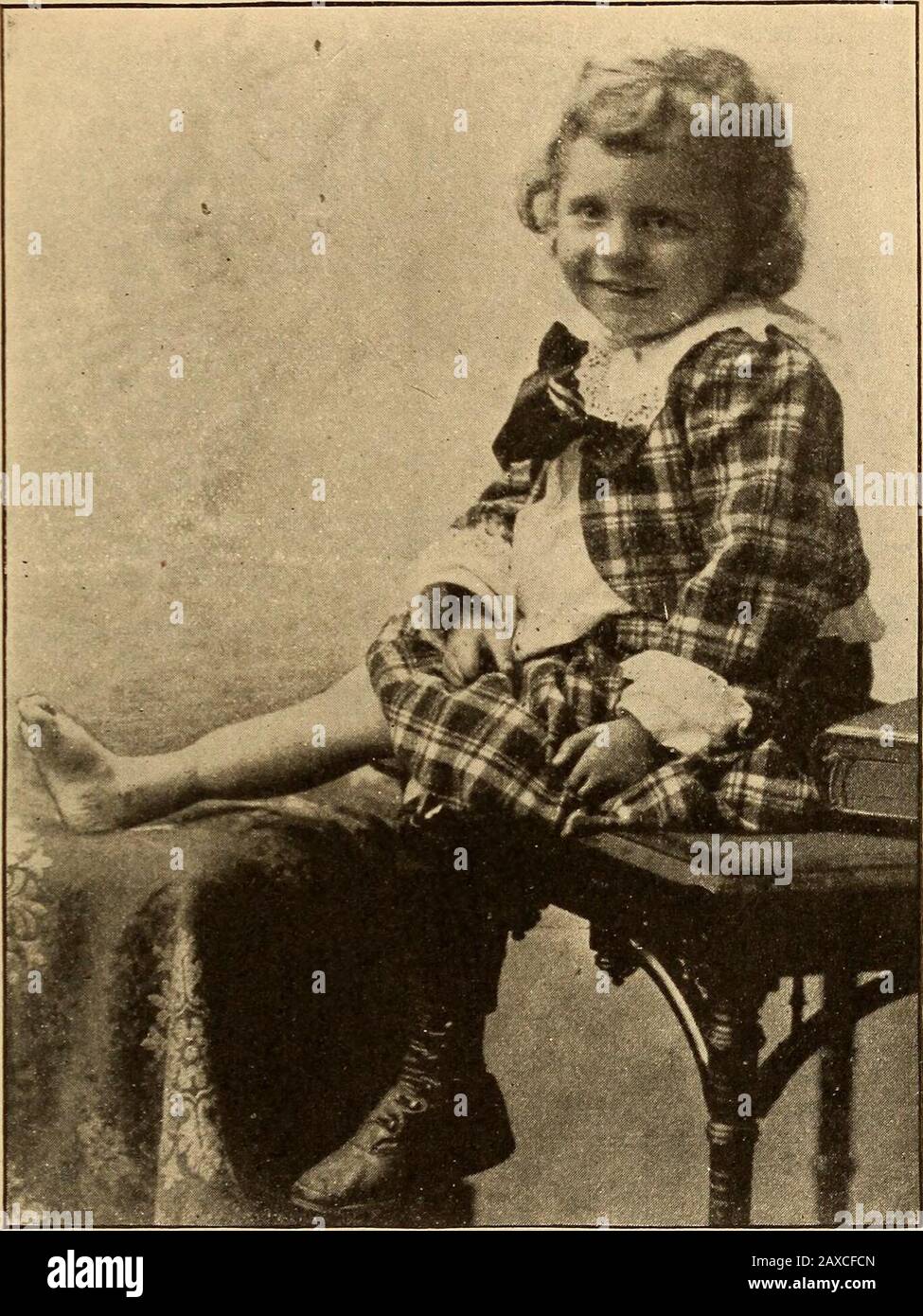 Congenital constriction bands hi-res stock photography and images - Alamy