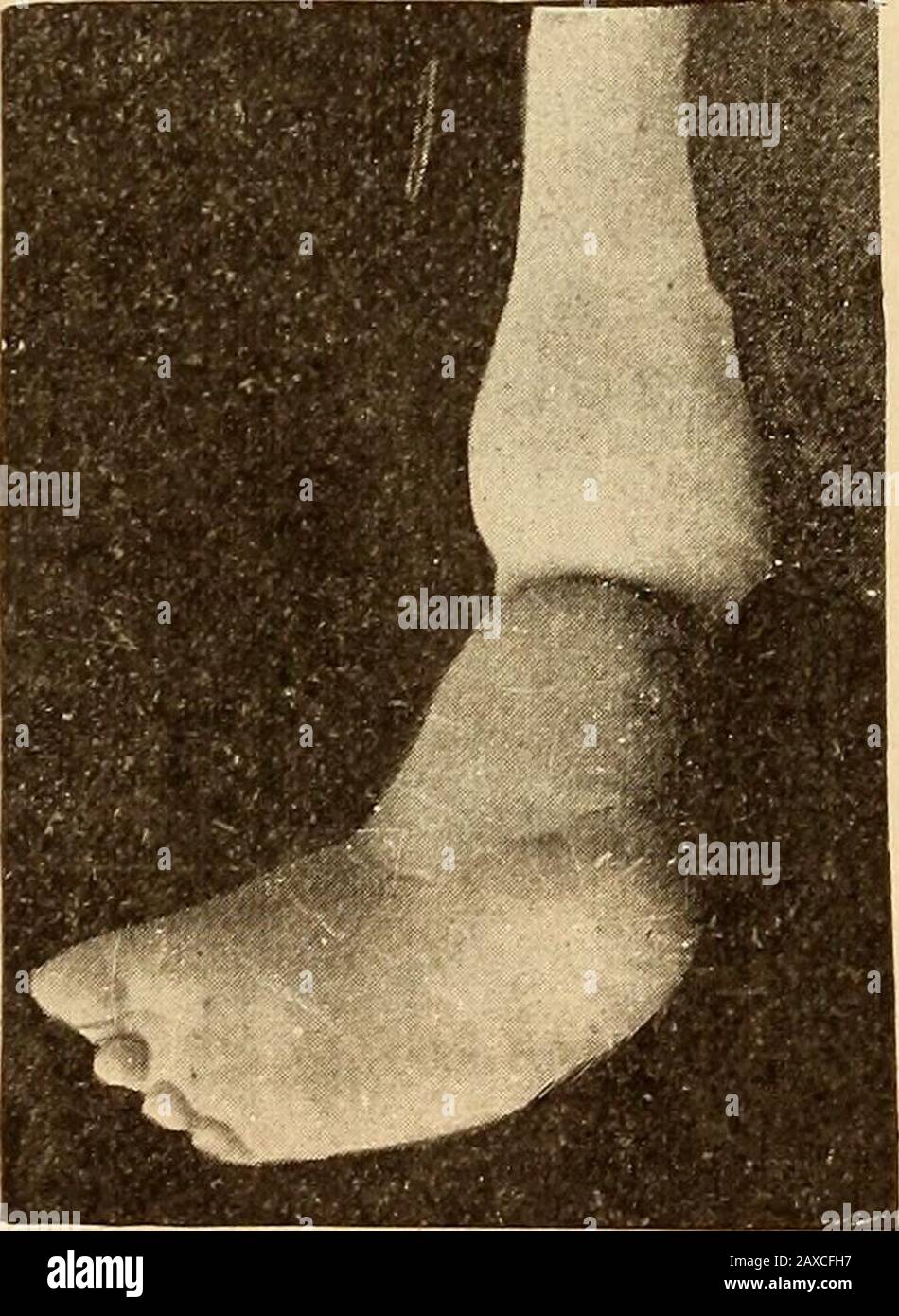 Congenital constriction bands hi-res stock photography and images - Alamy