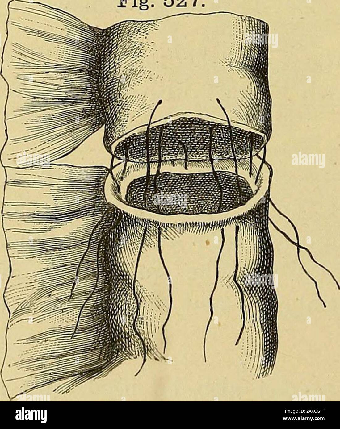 Continuous suture hi-res stock photography and images - Alamy