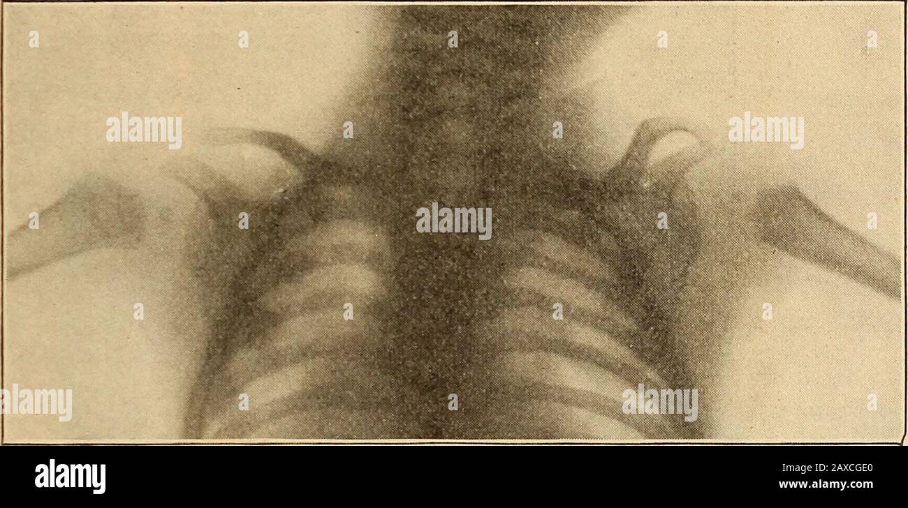 Lectures on orthopedic surgery . deepening of the crease between the ...