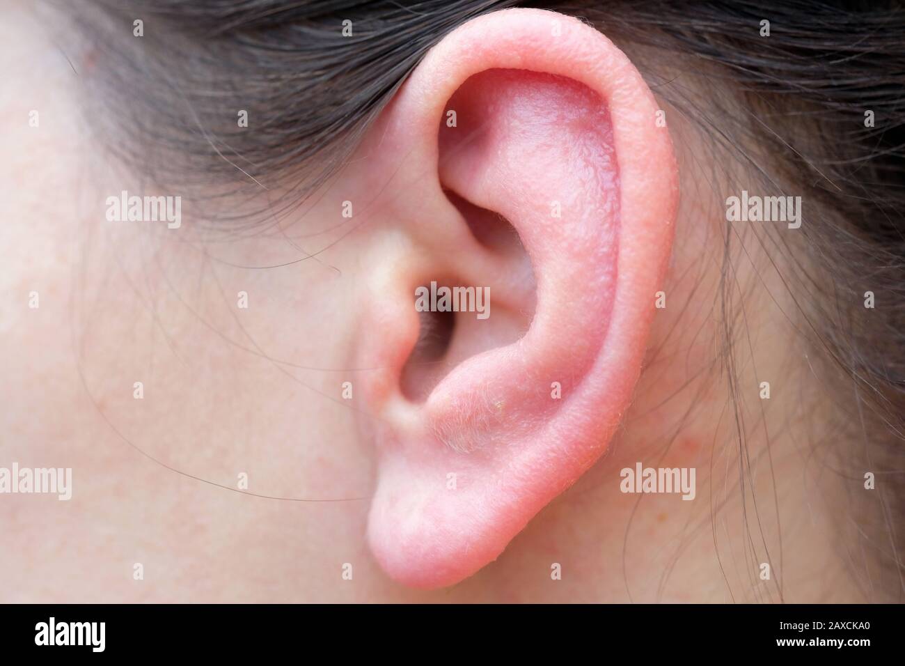 Pressure sore skin hi-res stock photography and images - Alamy