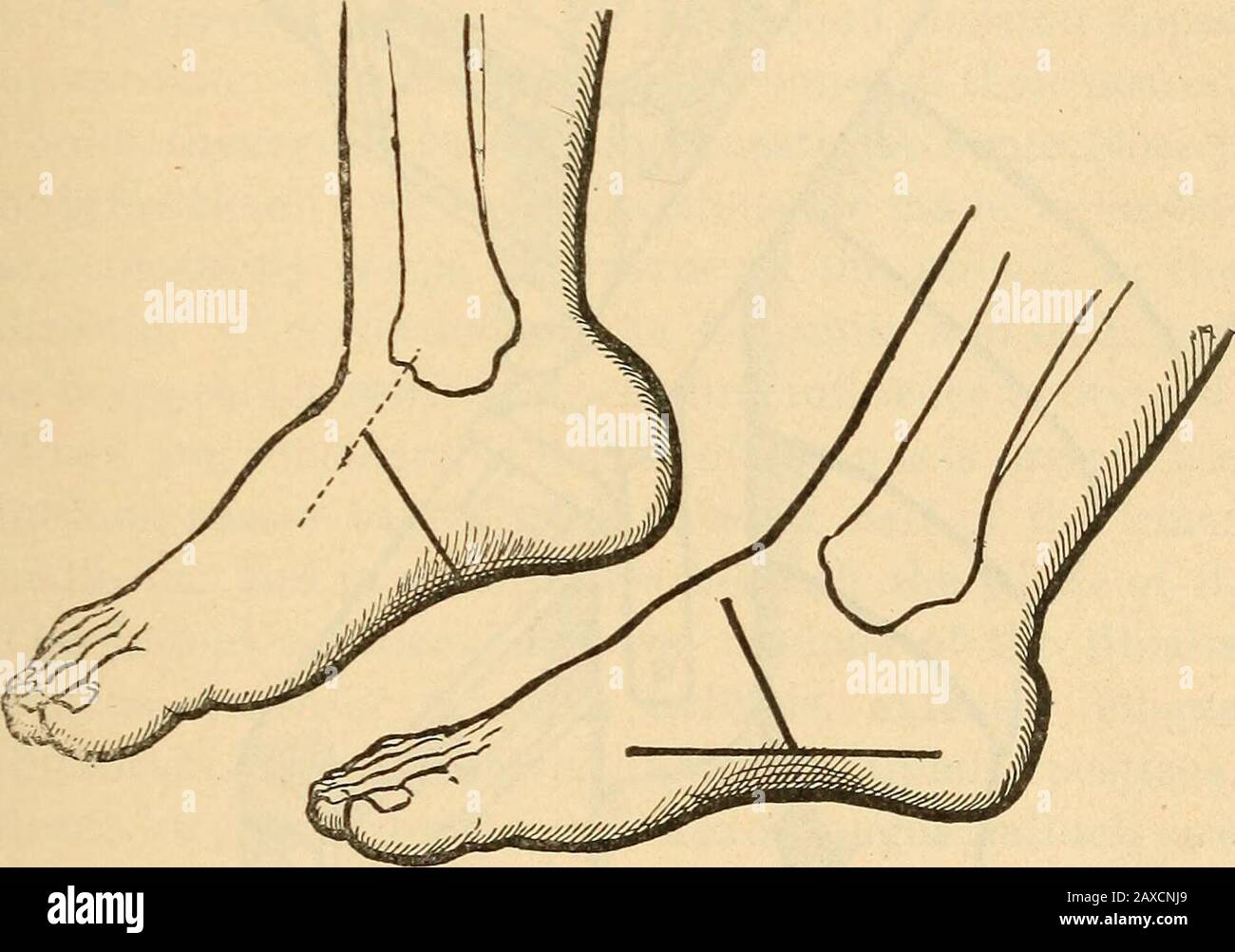 Lectures on orthopedic surgery . wound the adductor pollicis, tibi-alis ...