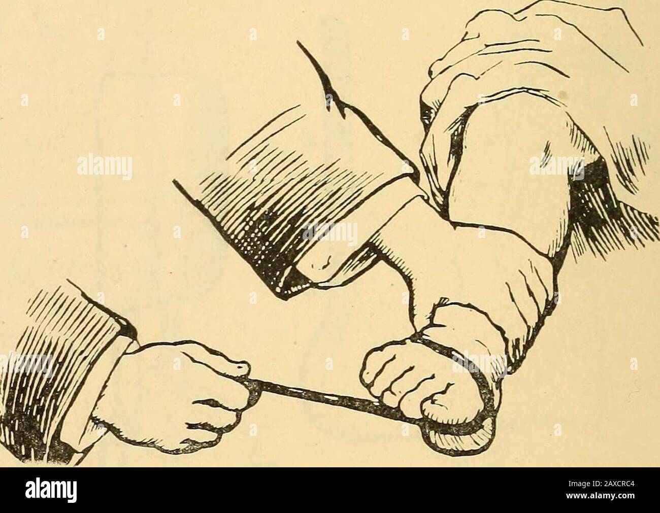 Clubfoot brace hi-res stock photography and images - Alamy