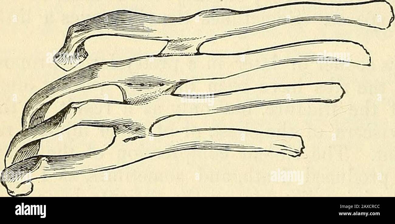 Rib fractures hi-res stock photography and images - Alamy