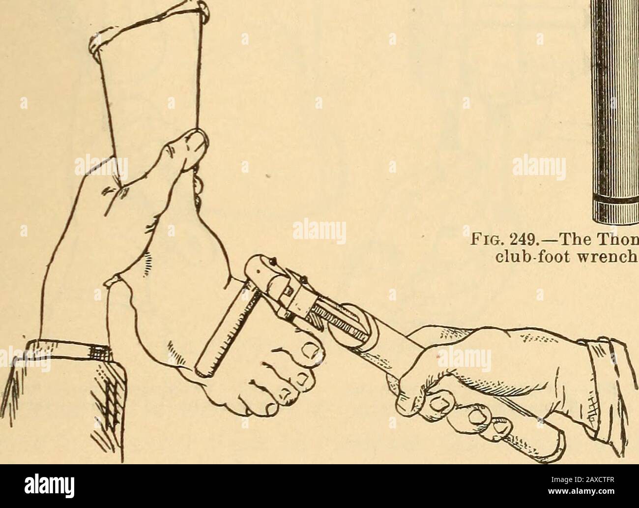 Clubfoot surgery hi-res stock photography and images - Alamy