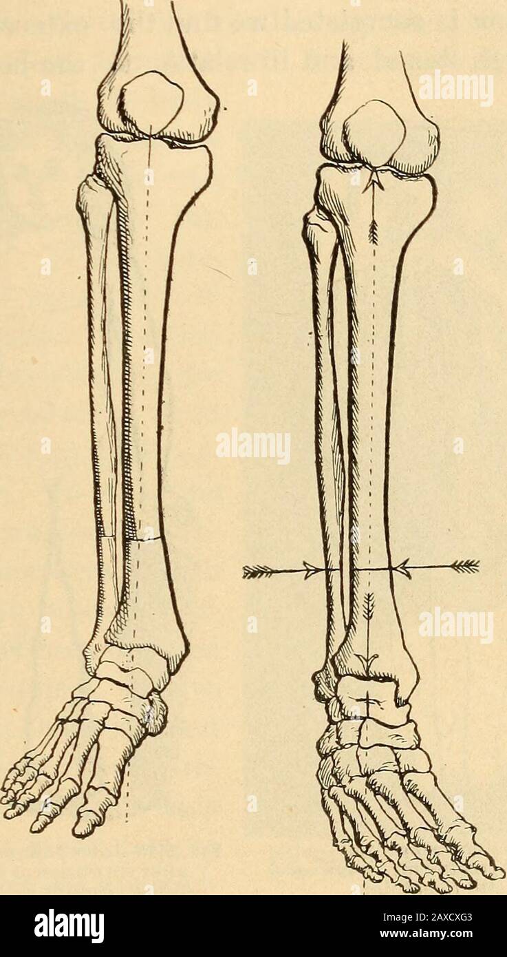 Equinovarus hi-res stock photography and images - Alamy