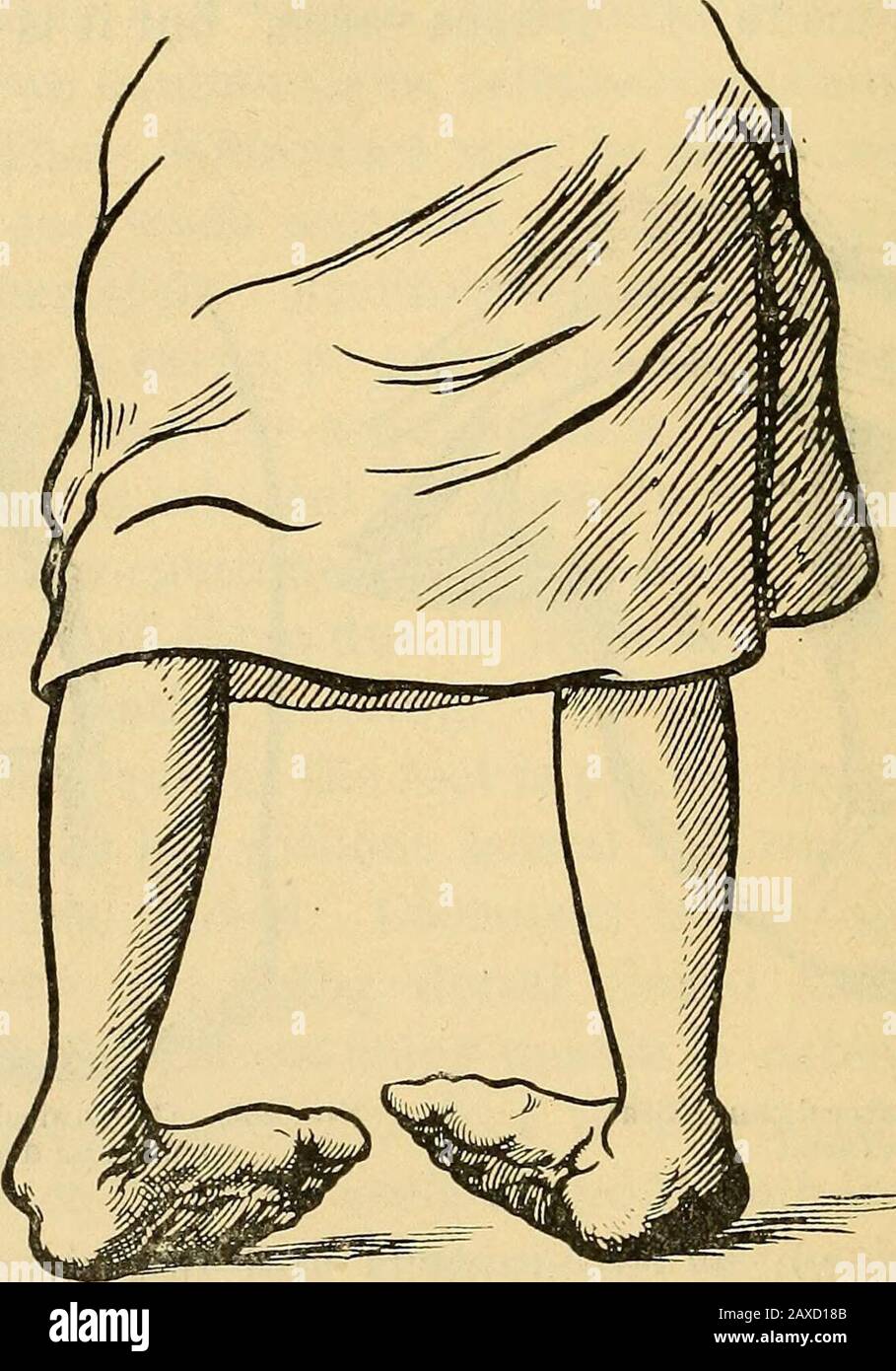 Equinovarus hi-res stock photography and images - Alamy