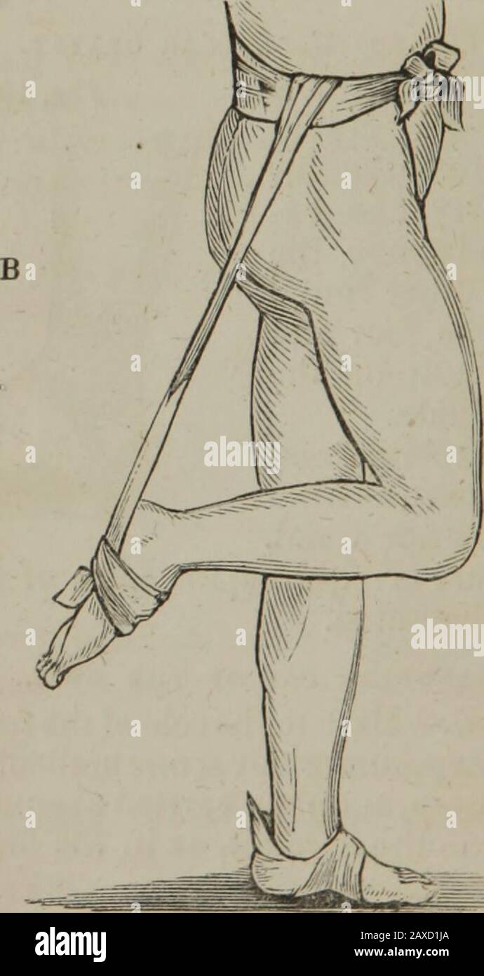 Minor surgery, or, Hints on the every-day duties of the surgeon . 152 ...