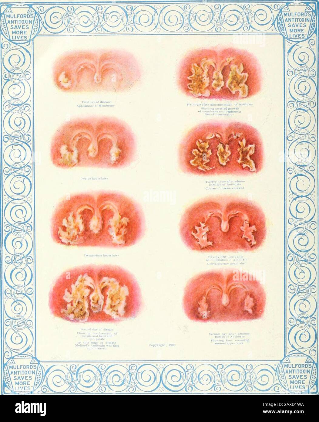 Diphtheritic membrane hi-res stock photography and images - Alamy