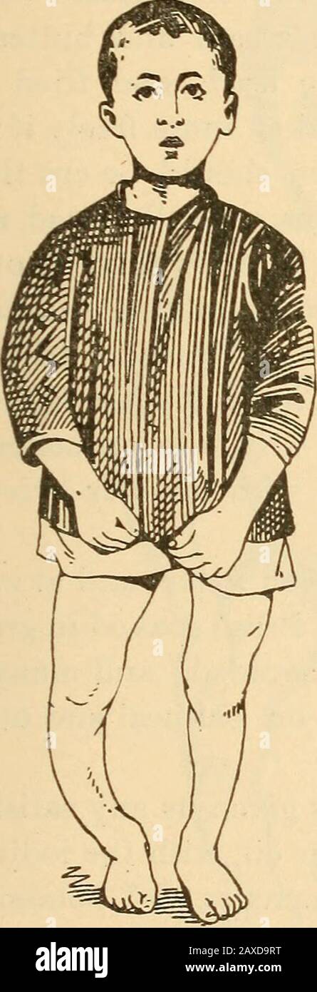 Lectures on orthopedic surgery . Fig. 208.—a case of bowlegs affecting ...