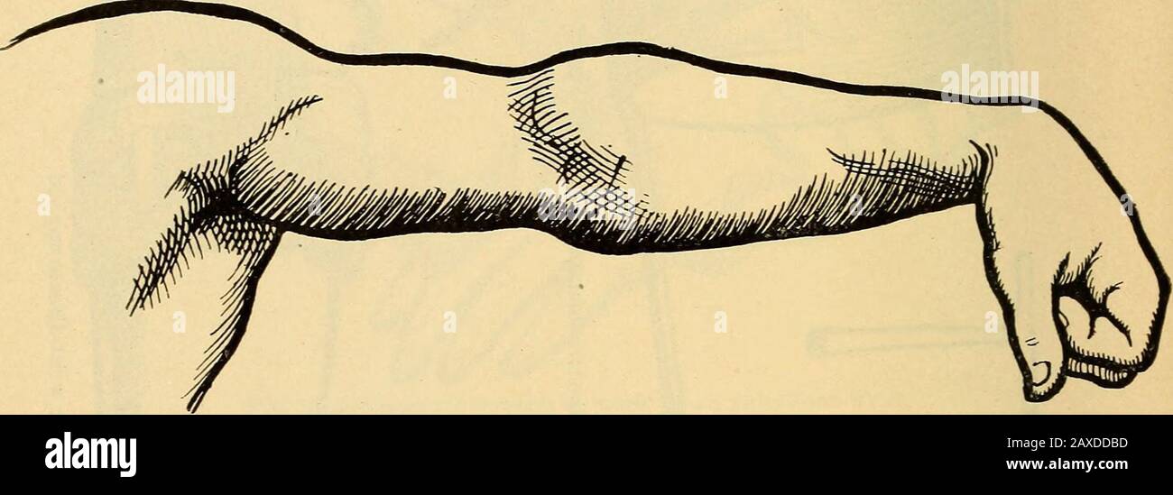 Lectures on orthopedic surgery . 246 stinctively extended. One cannot ...