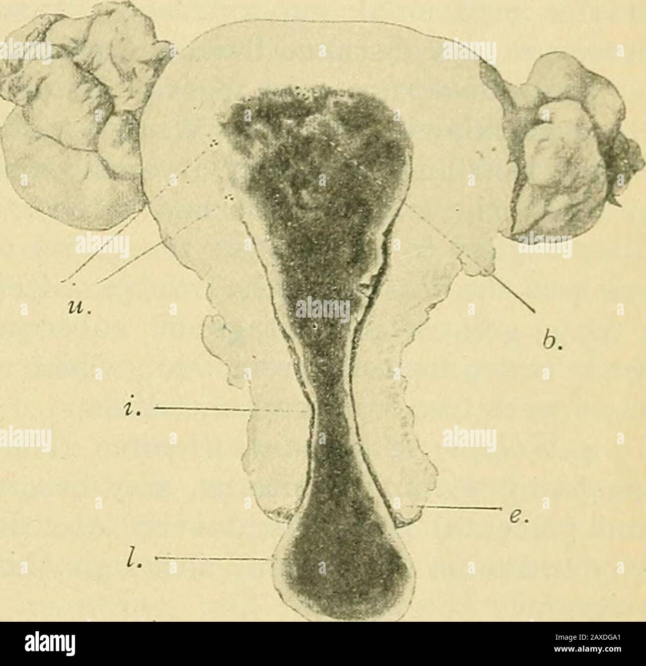 Septic abortion hi-res stock photography and images - Alamy