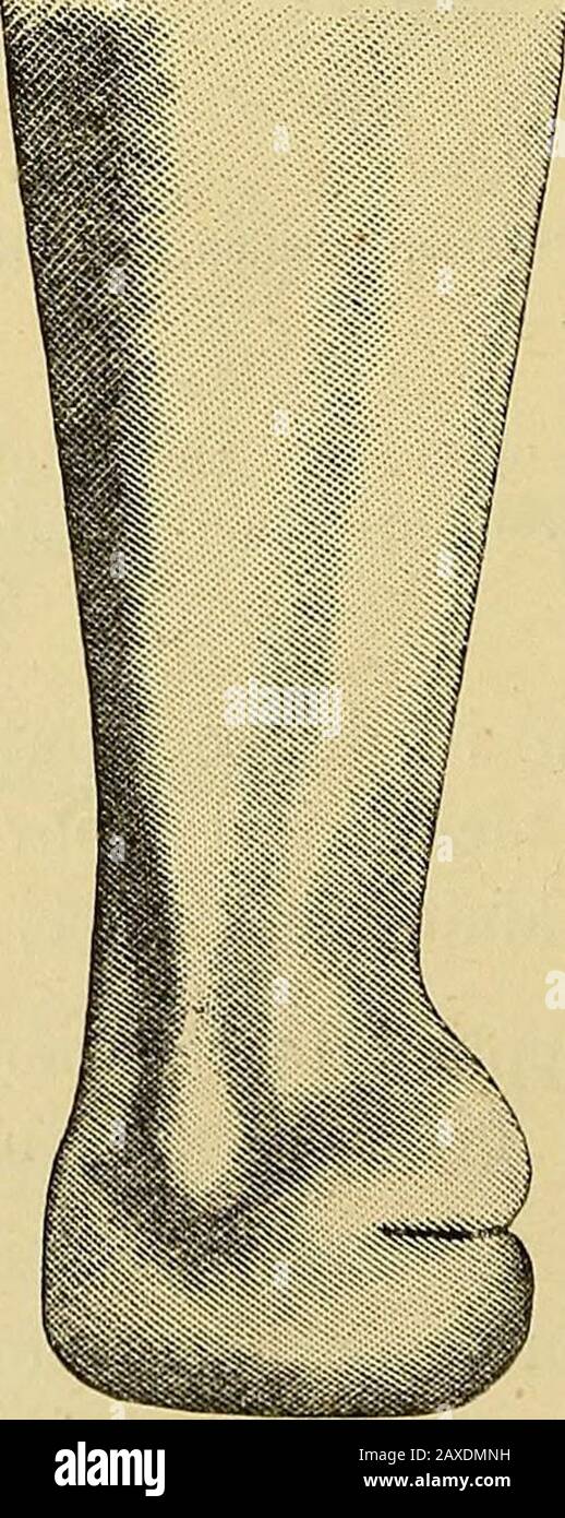 Syme amputation hi-res stock photography and images - Alamy