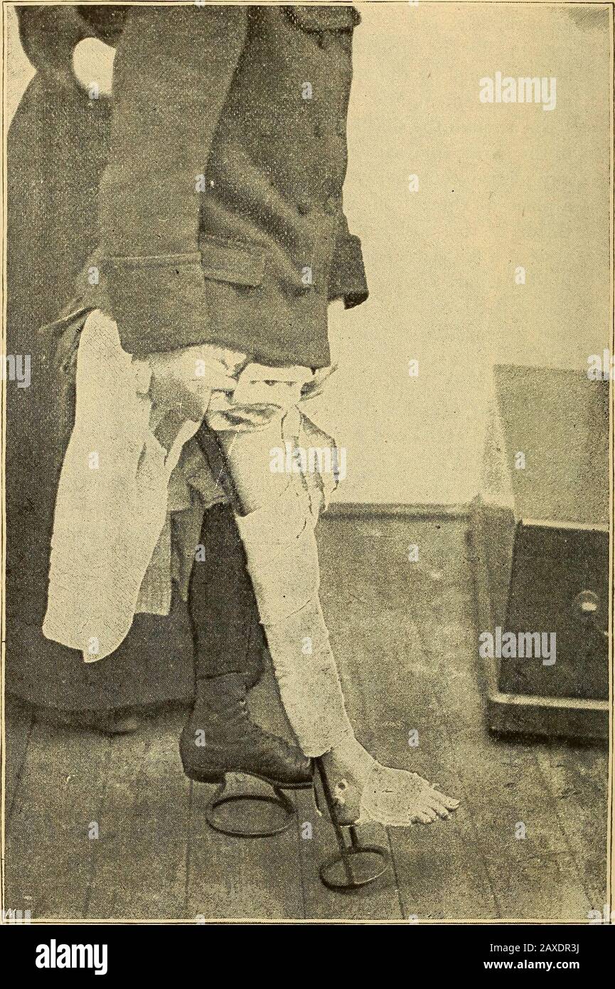 Lectures on orthopedic surgery . ke metal long enough to nearly ...