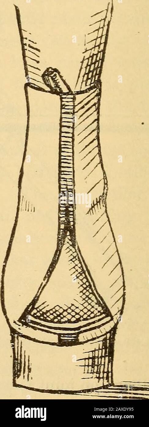 Thomas splint hi-res stock photography and images - Alamy