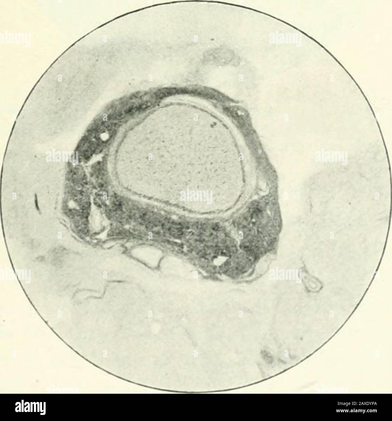 Transactions . Specimen No. 2. A human cyclops, showing the disc with ...
