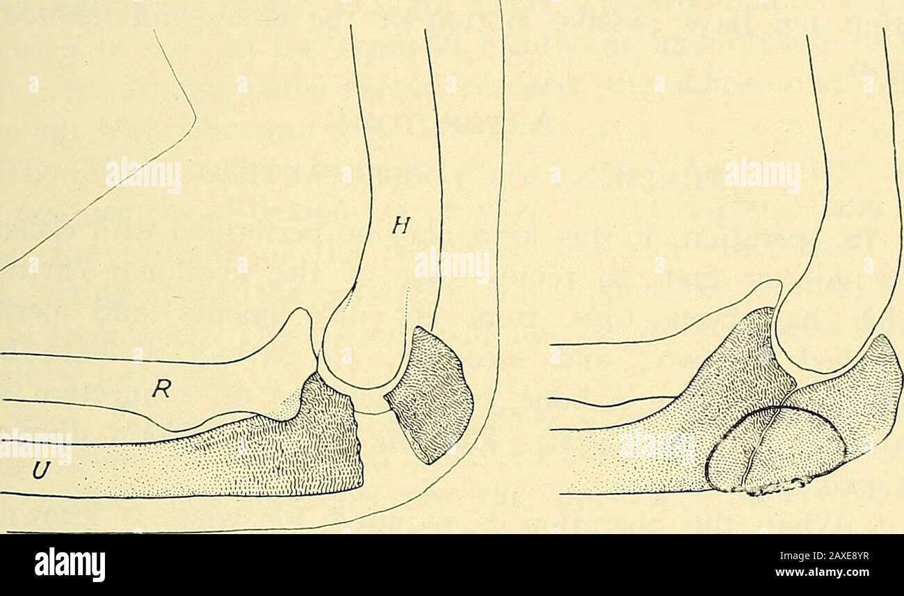Manual Muscle Operation High Resolution Stock Photography and Images ...