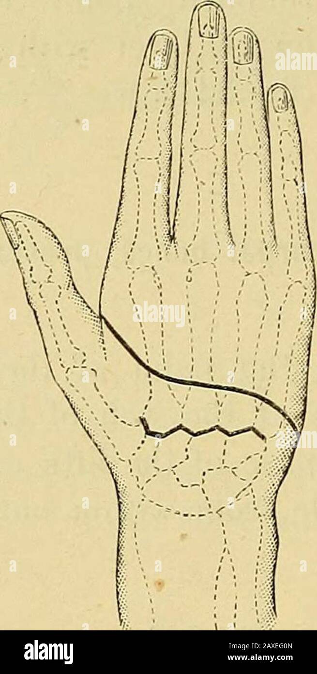 Palmar incision hi-res stock photography and images - Alamy