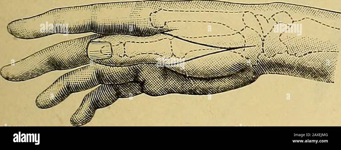 Radial incision hi-res stock photography and images - Alamy