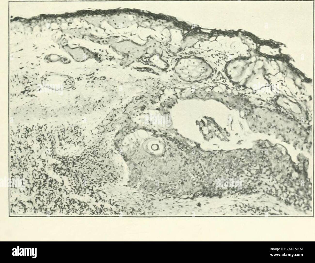 Malignant transformation hi-res stock photography and images - Alamy