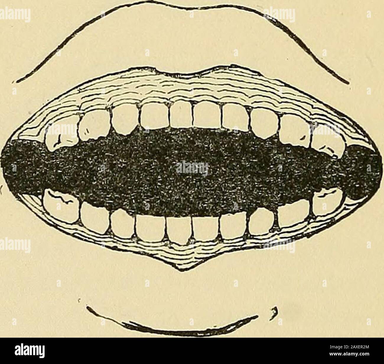 Marasmus hi-res stock photography and images - Alamy