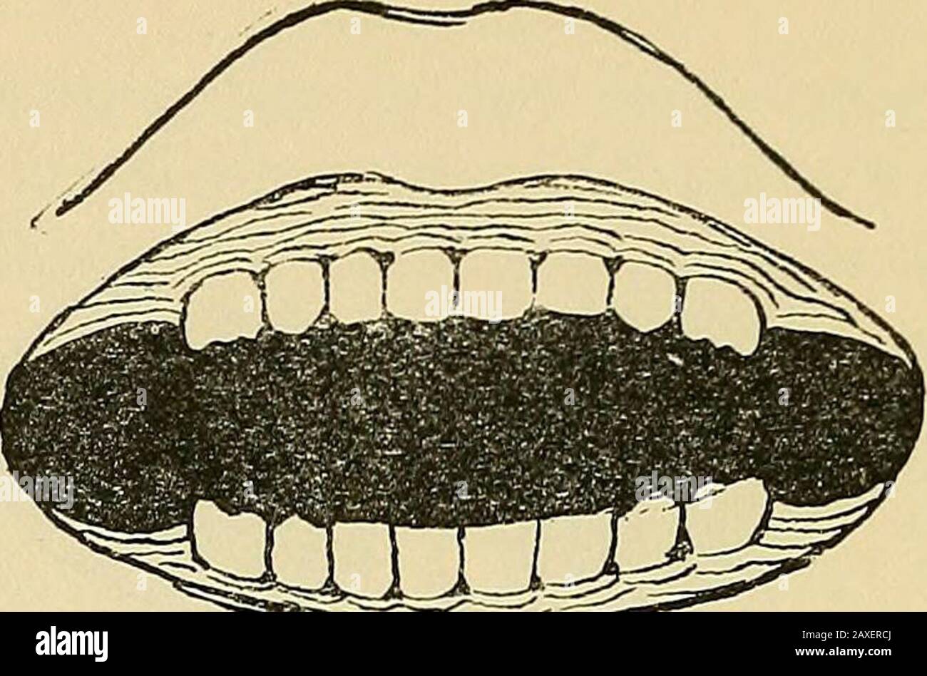 Infant-feeding in its relation to health and disease, by Louis Fischer ...