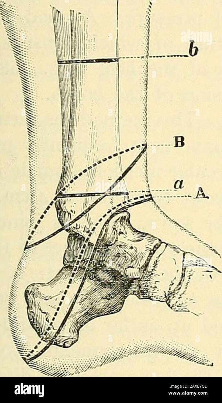 A manual of operative surgery . de it passesa little in front of the ...