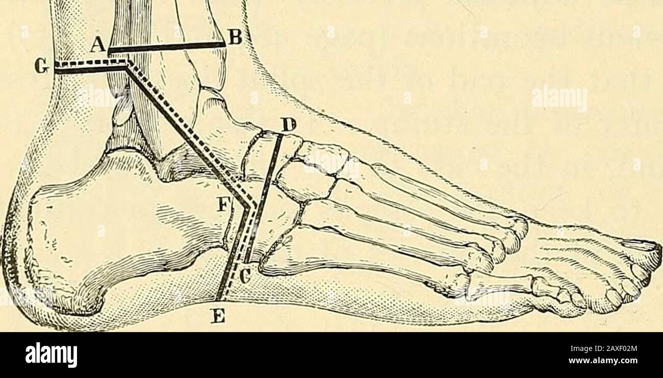 A manual of operative surgery . ver be passed—as is sometimesdone in ...