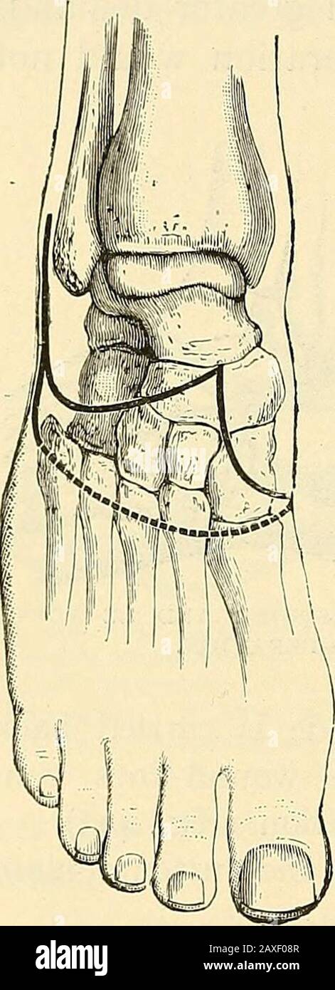 A manual of operative surgery . evel basisof support. An excellent flap ...