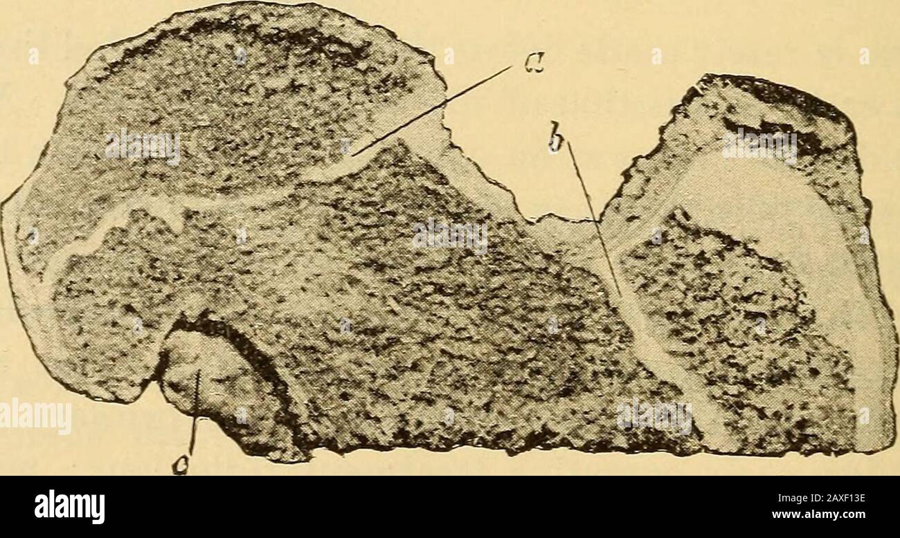 Lectures on orthopedic surgery . Fig. 81.—Cone-shaped sequestrum ...