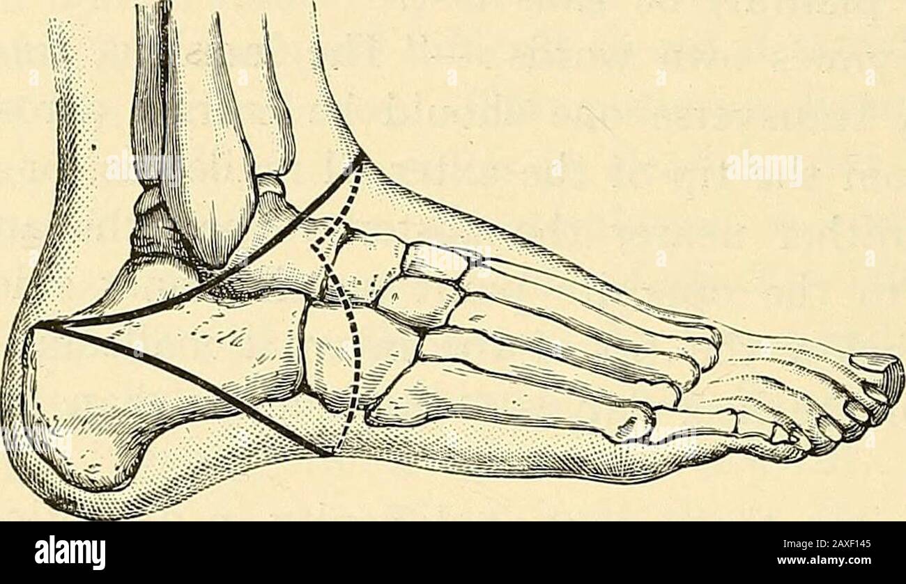 Symes amputation hi-res stock photography and images - Alamy