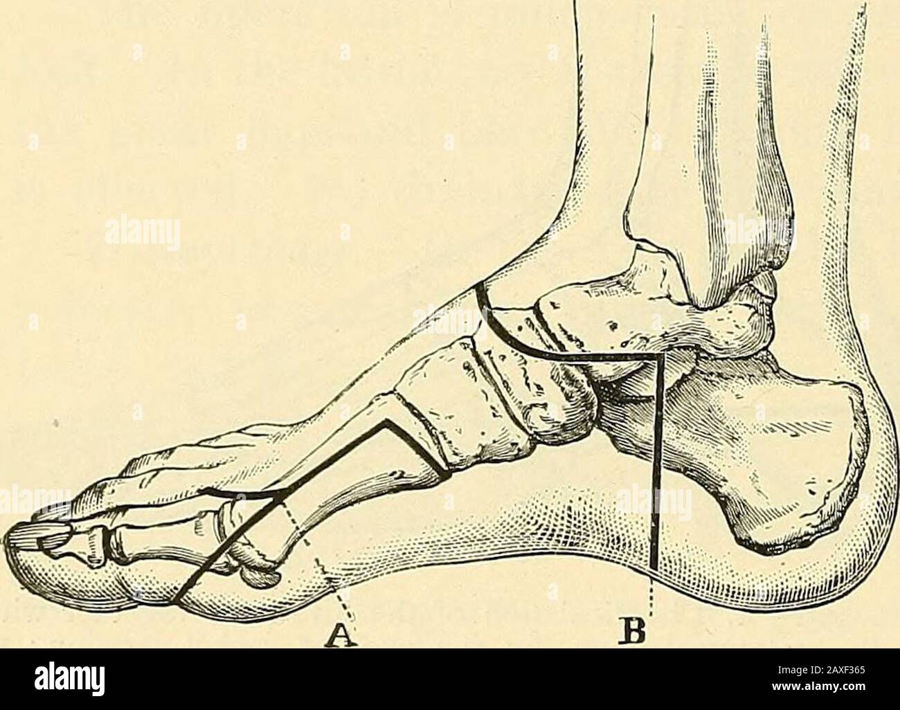 Symes amputation hi-res stock photography and images - Alamy