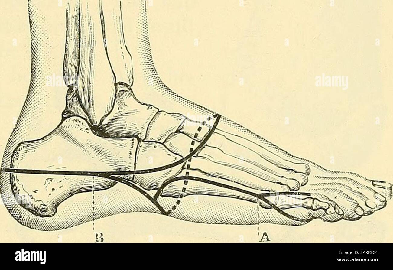 Symes amputation hi-res stock photography and images - Alamy